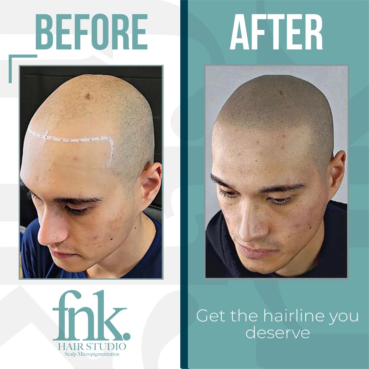 Scalp Micropigmentation for Men - FNK Hair Studio